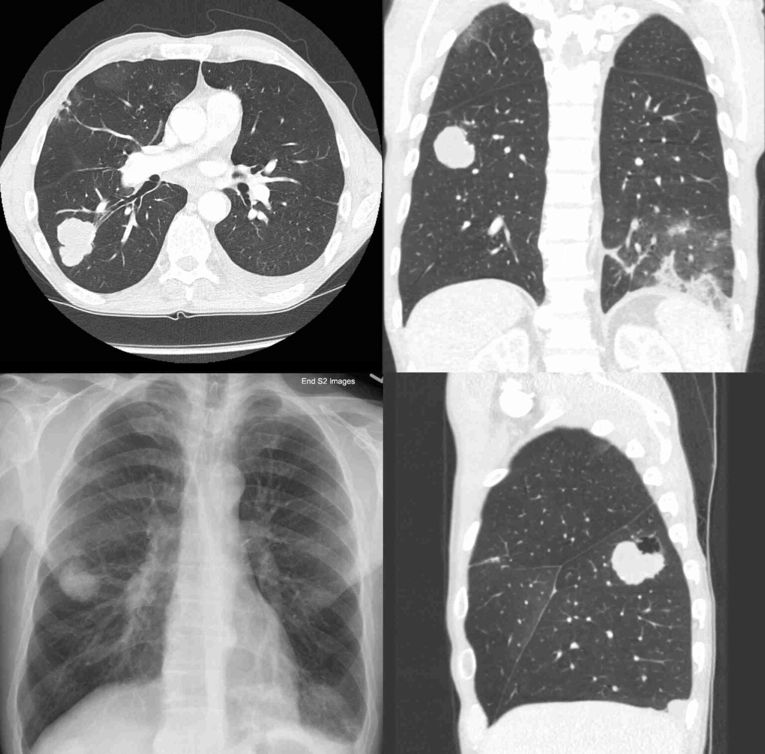 Aspergilloma (Fungus Ball in Lungs): Causes, Symptoms