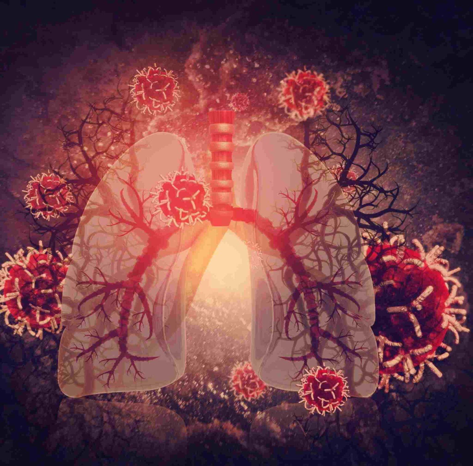 Aspergilloma (Fungus Ball in Lungs): Causes, Symptoms