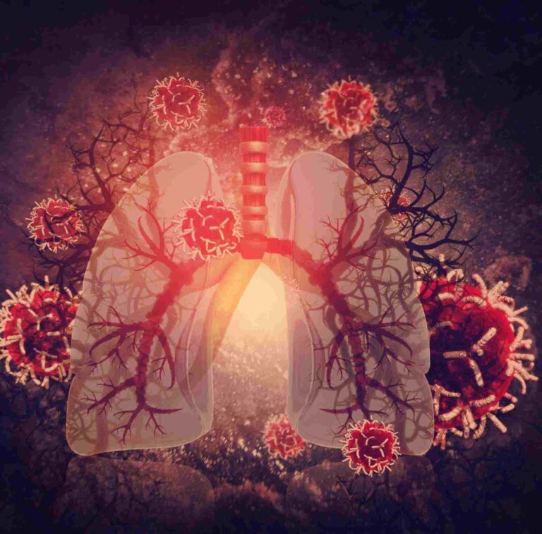 Aspergilloma (Fungus Ball in Lungs): Causes, Symptoms