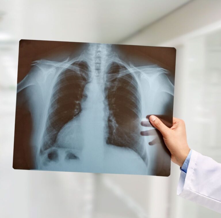 How Long Does It Take to Recover From Pleural Effusion Treatment? - Dr ...