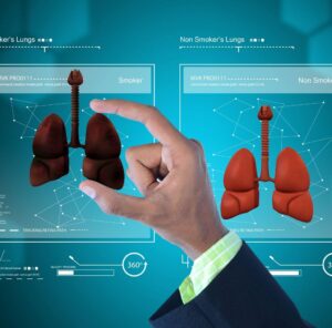 How Is Pleural Effusion Treated, and Is Drainage Necessary? - Dr Mohan ...