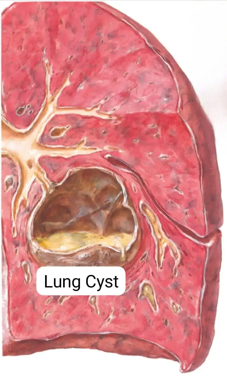 Lung Cysts: Causes, Symptoms & When Treatment is Needed
