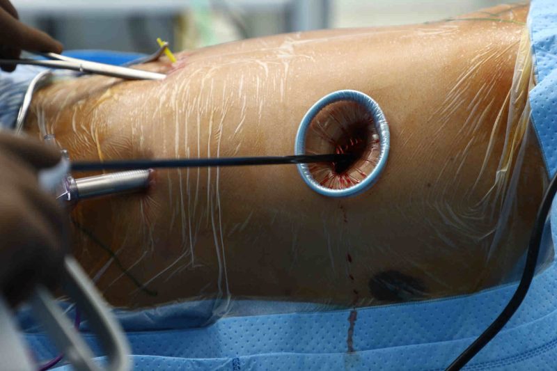 Expert Robotic Surgery in Hyderabad | Dr. Mohan Pulle